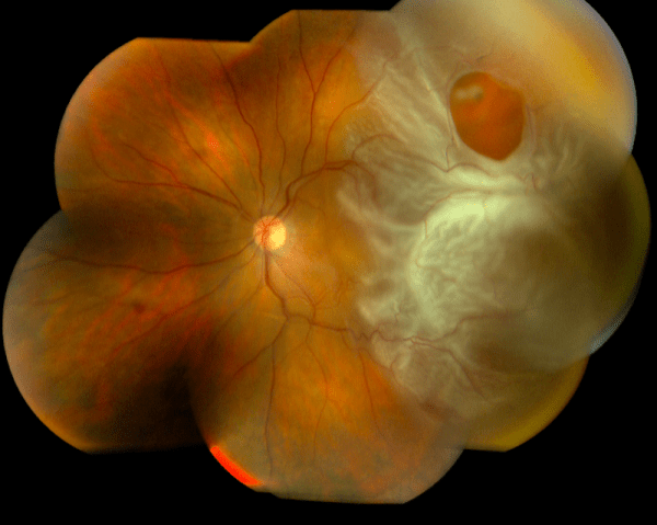 Retinal surgery & Injection | Shubhanu Eye Hospital